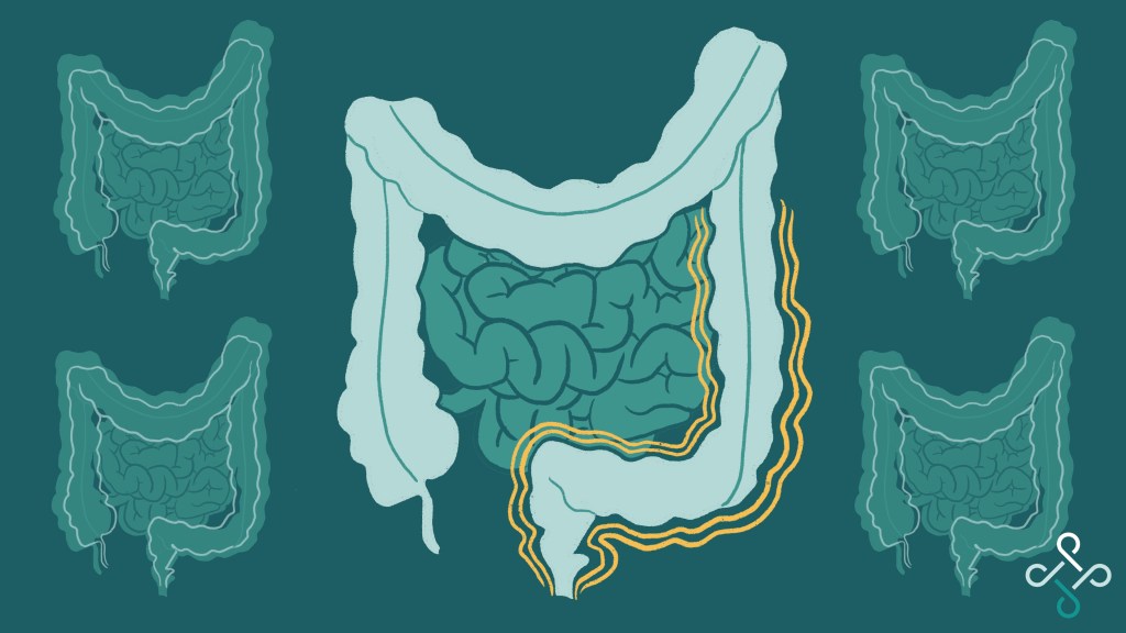 Spotlight on IBD: Ulcerative Colitis – Autoimmune Connect